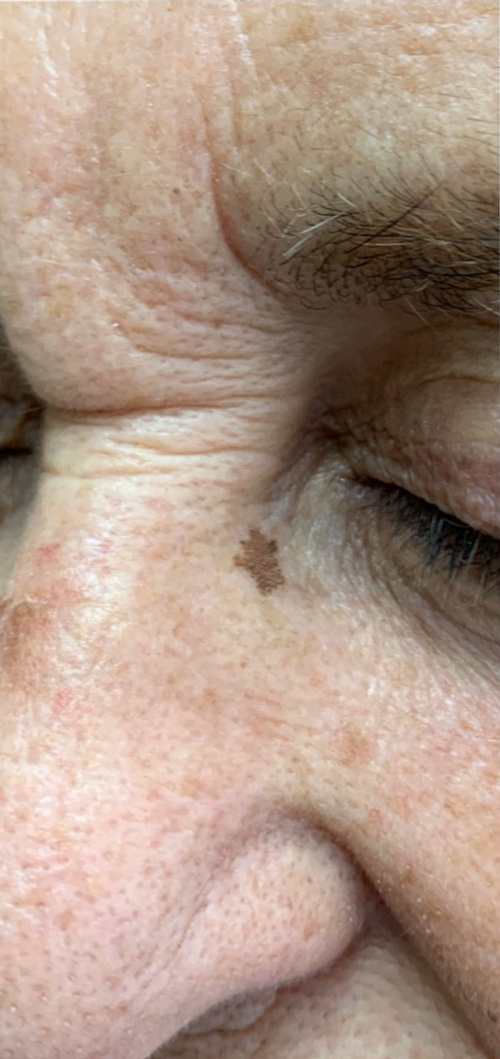 Tratamientos Luz pulsada y láser - Dermatólogo Carlos Durán · SANTANDER