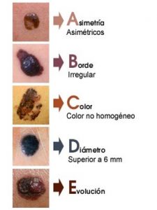 Tratamiento de lunares por dermatólogo Carlos Durán en SANTANDER