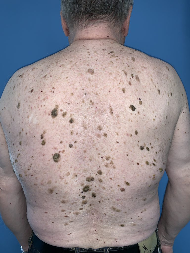 Las canas de la piel: QUERATOSIS SEBORREICAS - Dermatólogo Carlos Durán